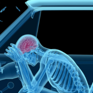 THE IMPORTANCE OF X-RAYS AFTER AN AUTO ACCIDENT - Paragon Imaging